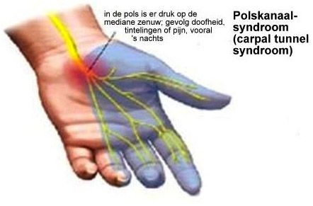 Carpaal tunnel syndroom - Medisch Centrum Waalre